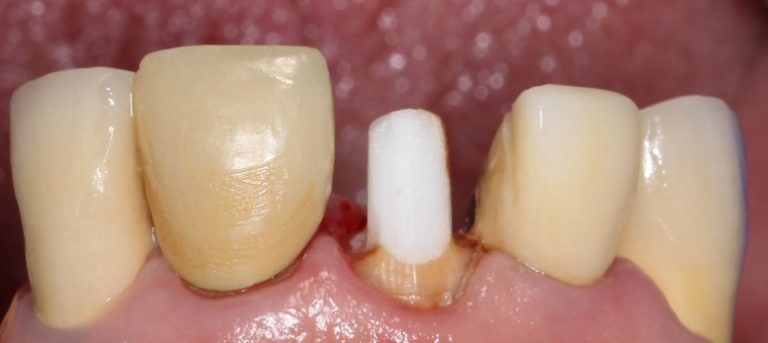 Séquence RMIPP (Tenon fibré etc.) – Odontoulouse