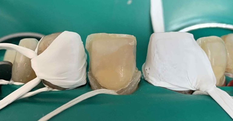 Teflon – Odontoulouse